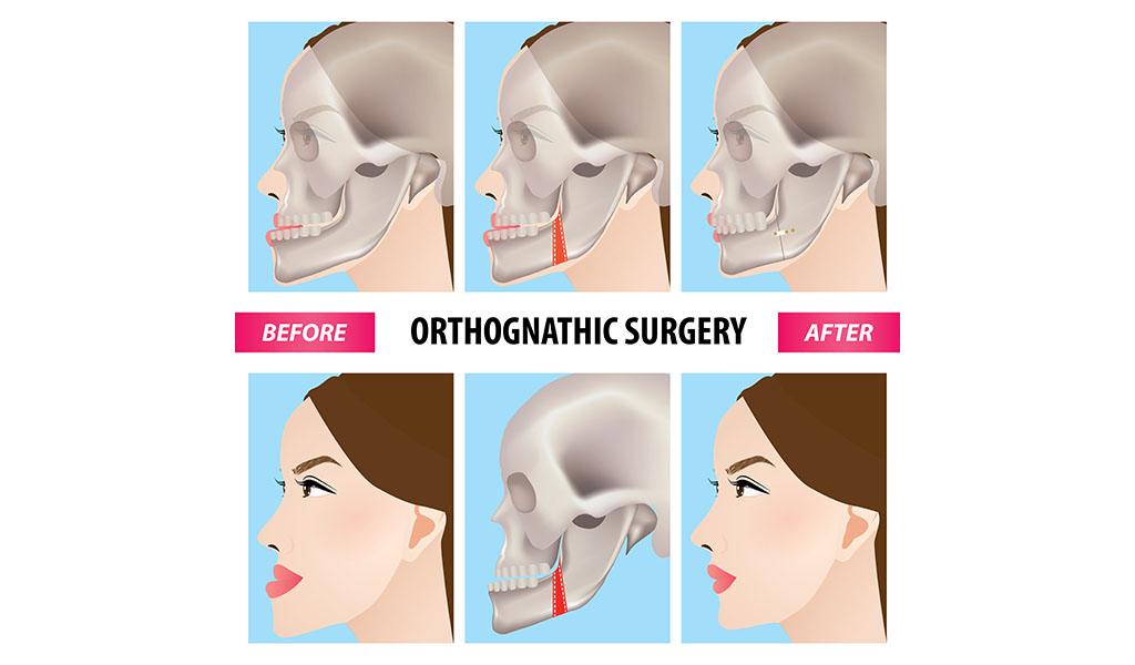Dr Allie Mohamed Orthognathic Surgery